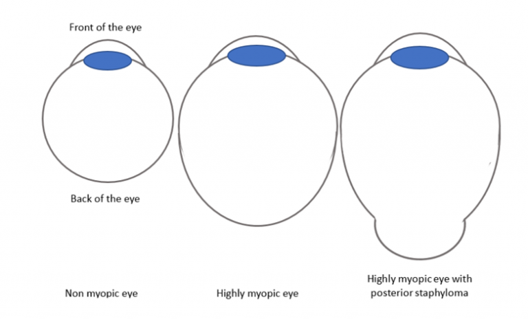 High Myopia | Asia Pacific Eye Centre